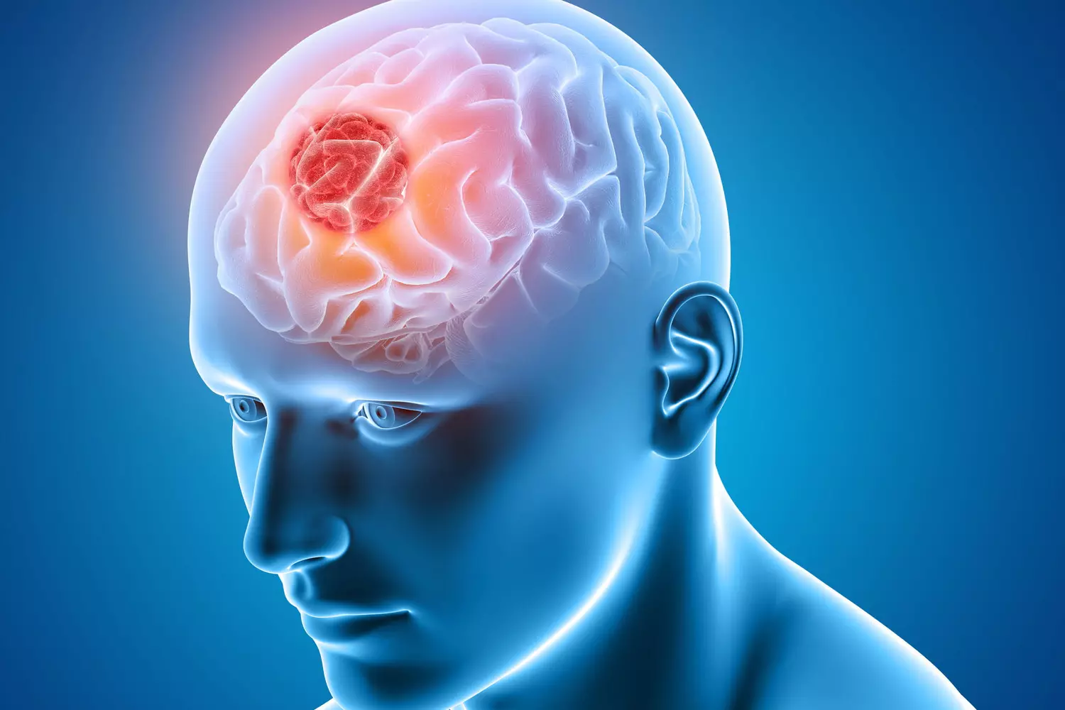 SANTE: Les symptômes d’une tumeur au cerveau - Evasion